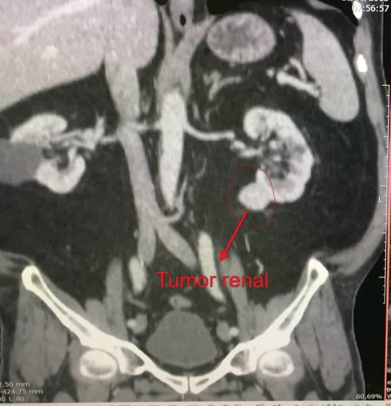 Câncer de Rim - Dr. Fernando Zapparoli